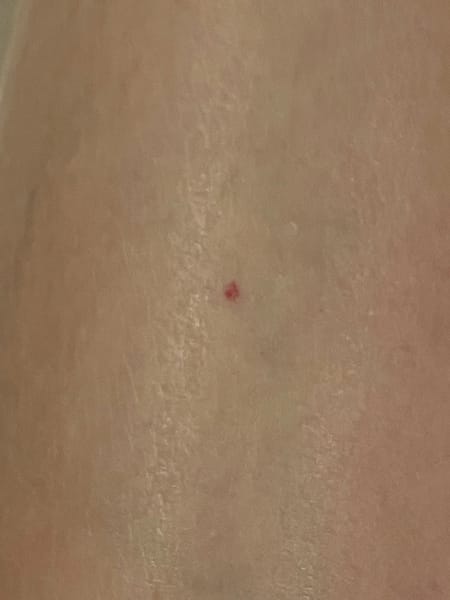 Safe and Effective Laser Treatment for Cherry and Spider Angiomas ...