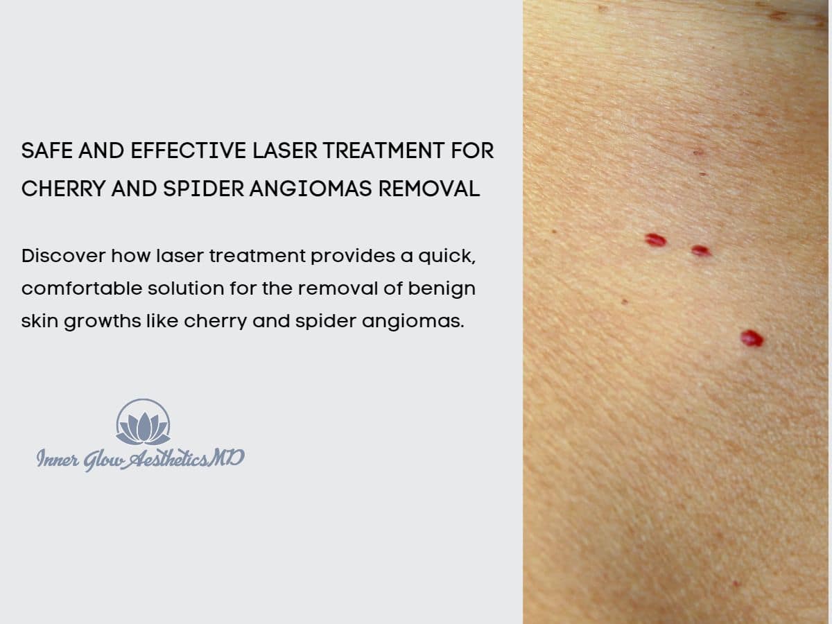 Safe and Effective Laser Treatment for Cherry and Spider Angiomas ...