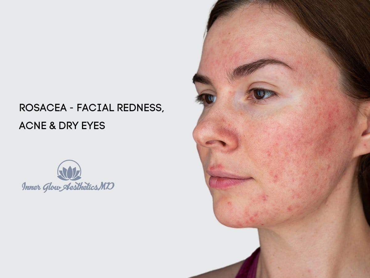 Rosacea - Facial Redness, Acne & Dry Eyes - Inner Glow AestheticsMD in ...